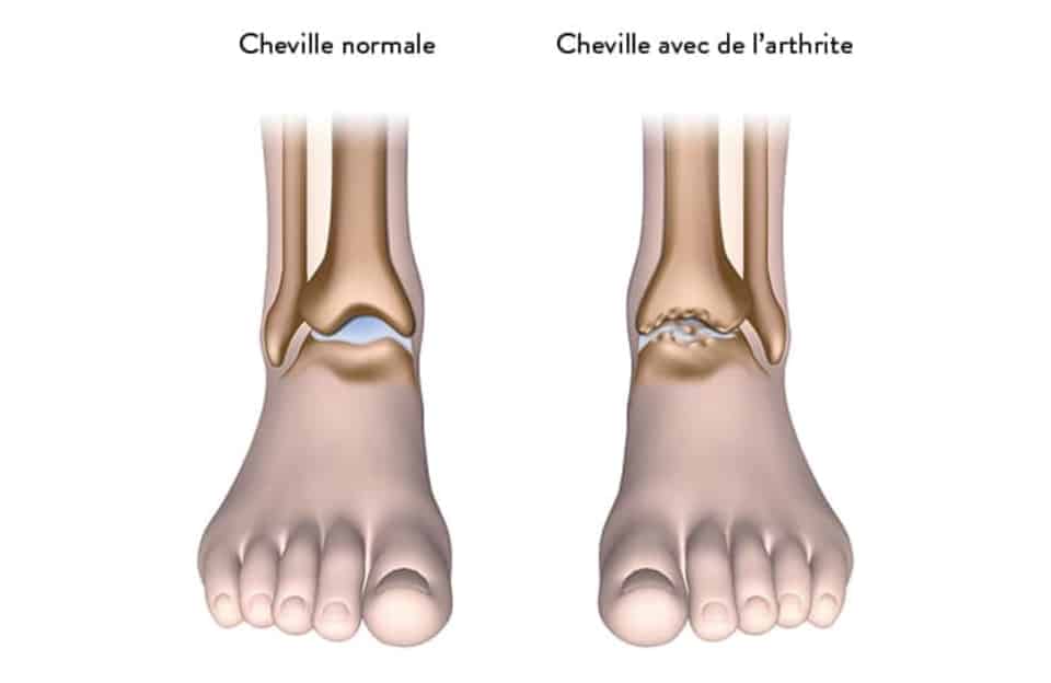 Cheville et pied article – Docteur Anis ACHARGUI