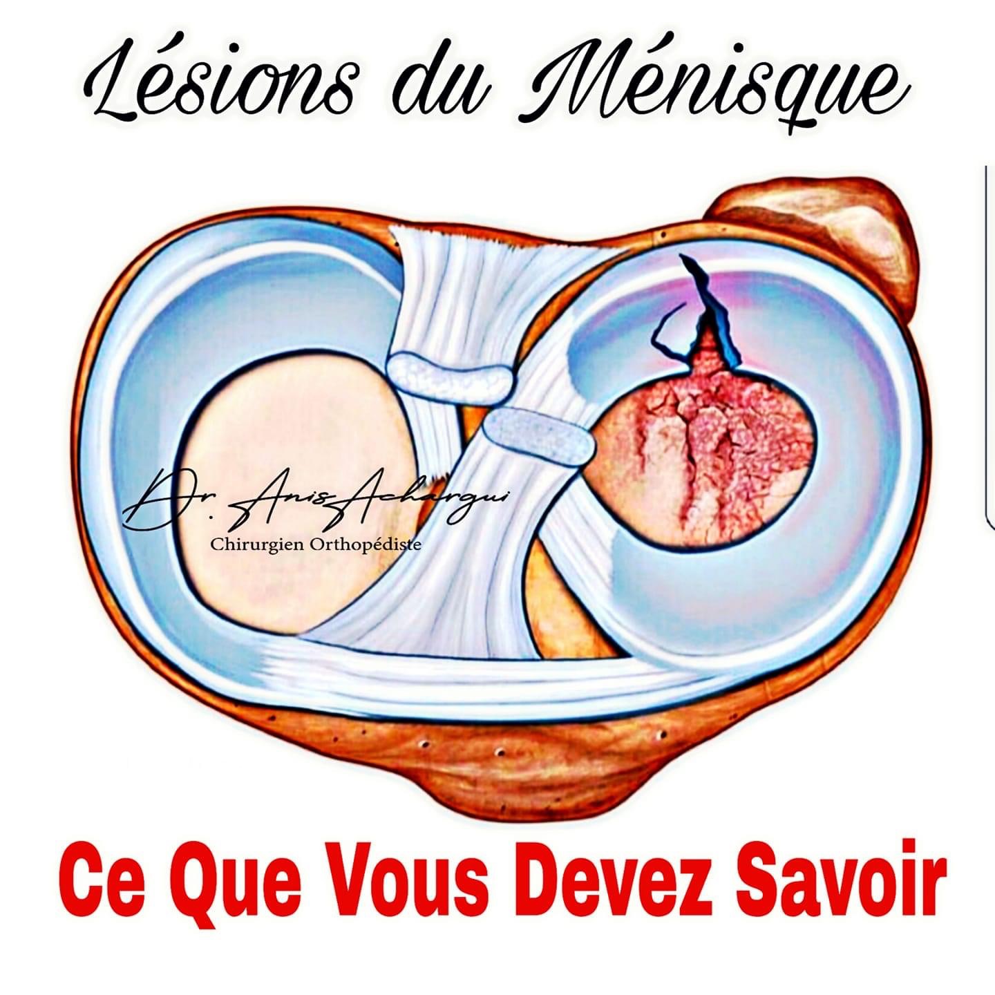Tout savoir sur les lésions du Ménisque - Docteur Anis ACHARGUI